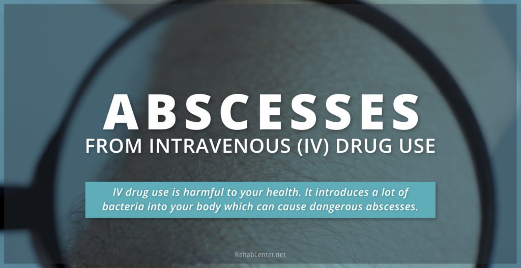 Abscesses From Intravenous (IV) Drug Use