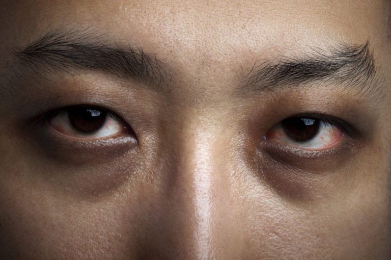 Examining a Drug Addict’s Face: What Drugs Do to Your Face - Rehab Center